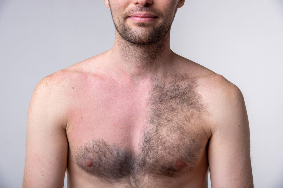 Common Laser Hair Removal Side Effects And How To Fix or Prevent Them